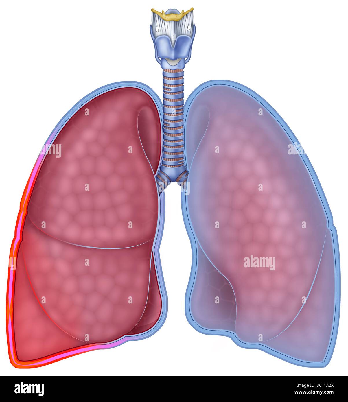 Lung with pleural inflammation hi-res stock photography and images - Alamy