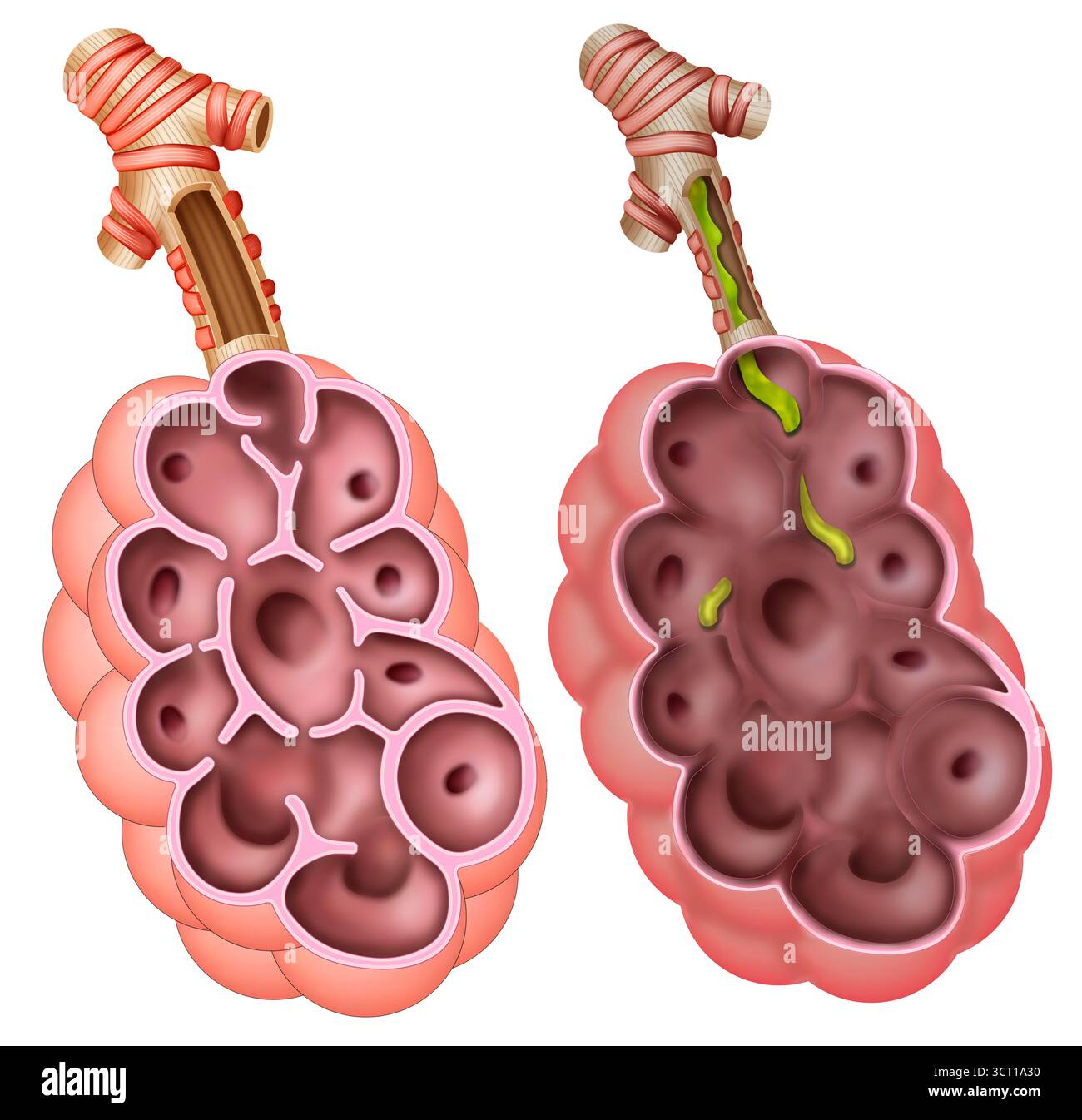 Illustration of two alveoli, one healthy (left) and the other with ...