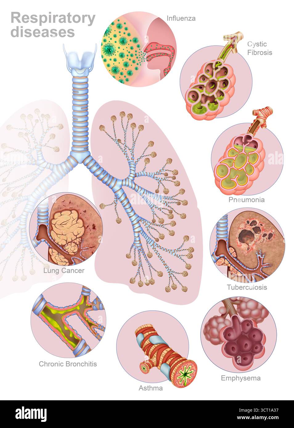 Illustration, with a section of the lung and bronchial branches in the ...