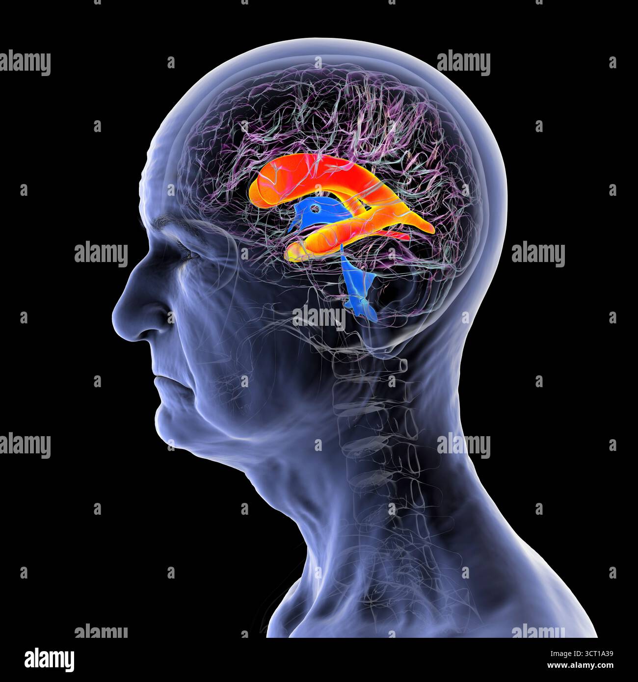 Illustration of the lateral brain ventricles in a senior person. These ...