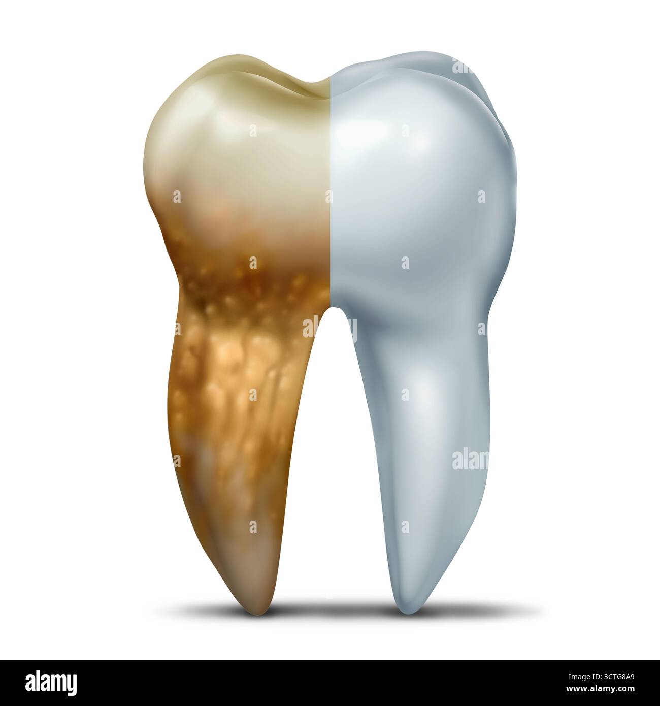 Bacterial plaque on teeth. hi-res stock photography and images - Alamy