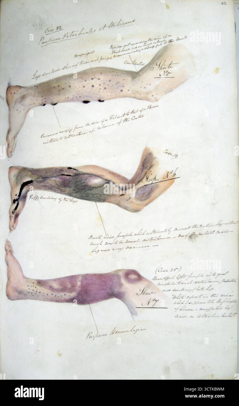 The effects of scurvy, February 1841. Page from the journal of surgeon ...