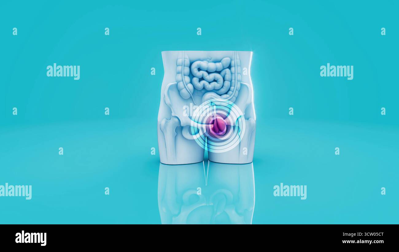 Conceptual 3D illustration of a human hernia Stock Photo - Alamy