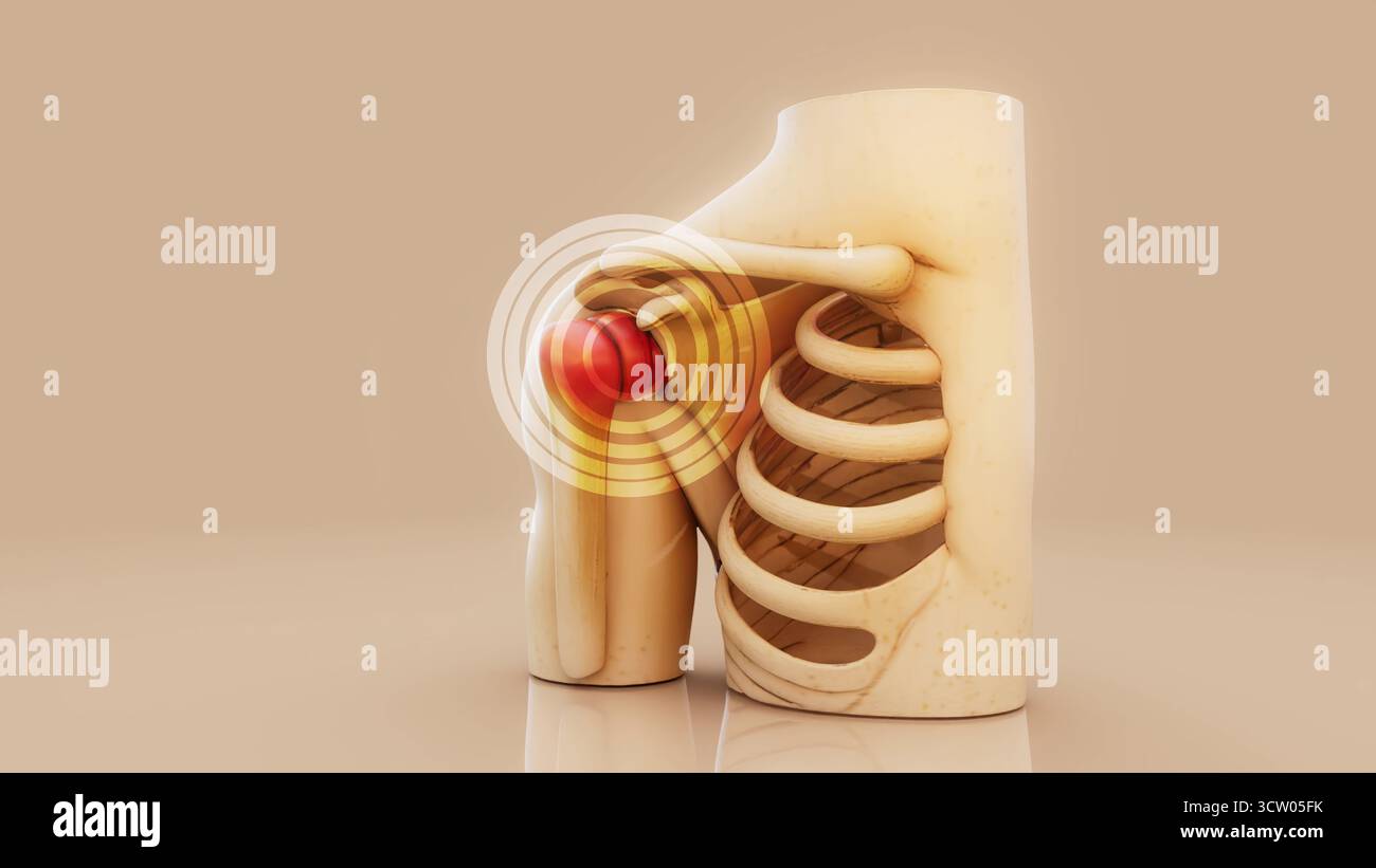 Conceptual 3D Animation of Shoulder Inflammation and Joint Pain Stock ...