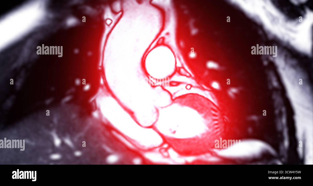 MRI heart stress test revealing detailed cardiac function under ...