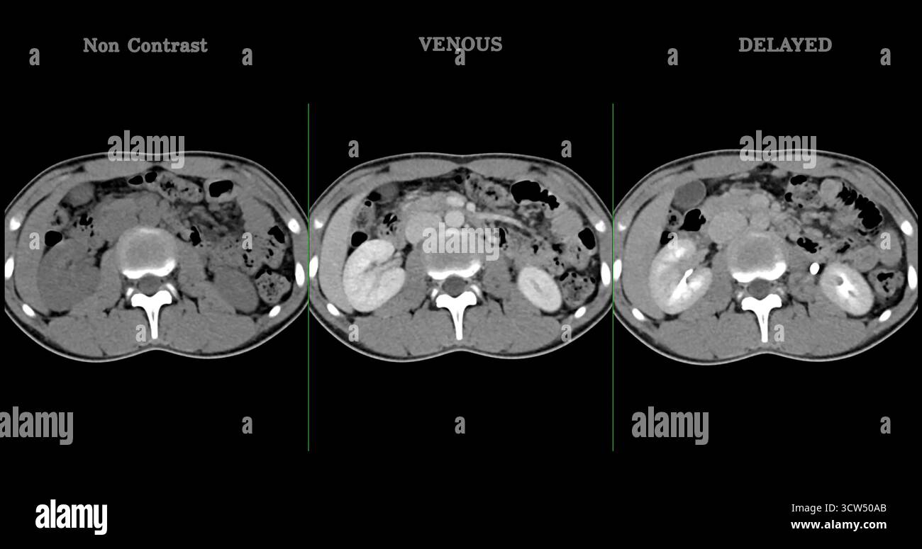 High-resolution CT scan Lower abdomen showing a normal lower abdomen ...