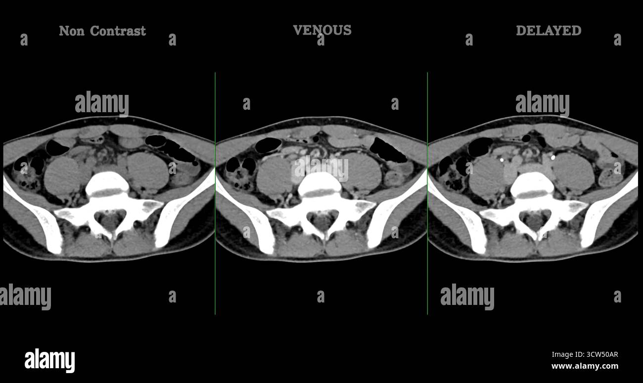 High-resolution CT scan Lower abdomen showing a normal lower abdomen ...