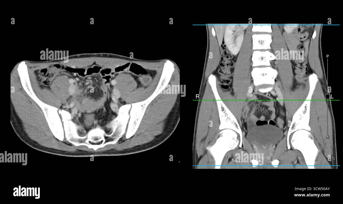High-resolution CT scan Lower abdomen showing a normal lower abdomen ...