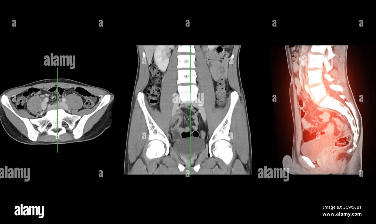 High-resolution CT scan Lower abdomen showing a normal lower abdomen ...