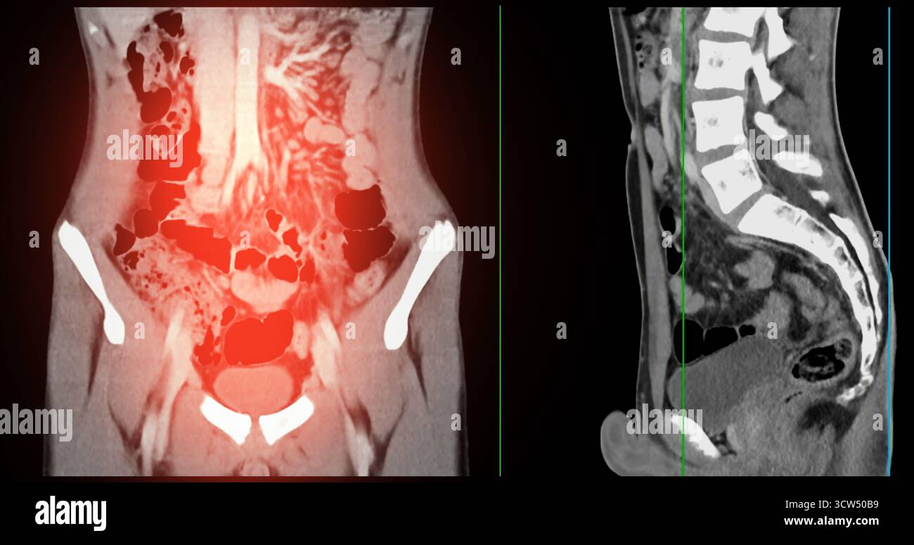 High-resolution CT scan Lower abdomen showing a normal lower abdomen ...