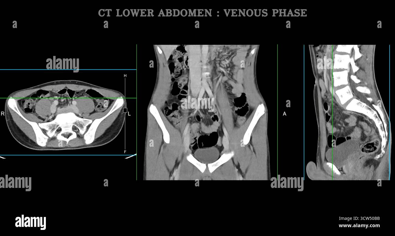 High-resolution CT scan Lower abdomen showing a normal lower abdomen ...