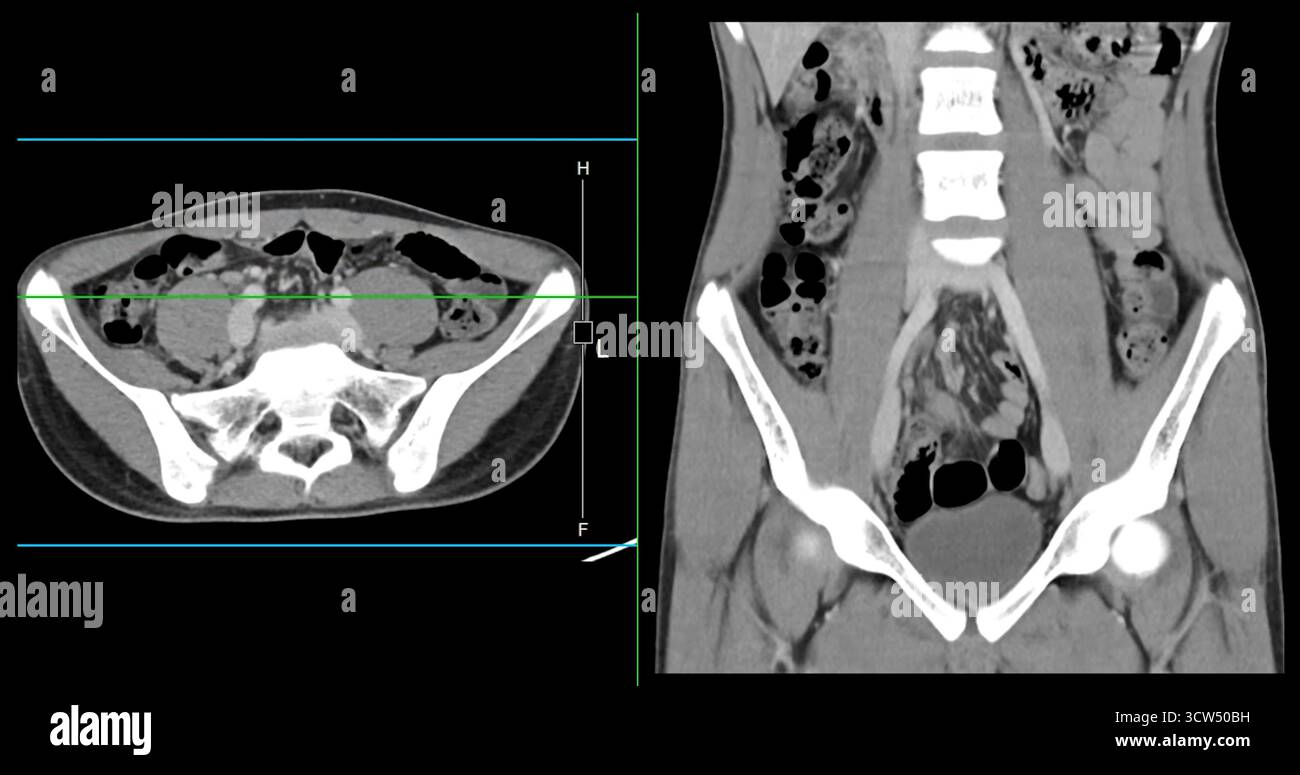 High-resolution CT scan Lower abdomen showing a normal lower abdomen ...