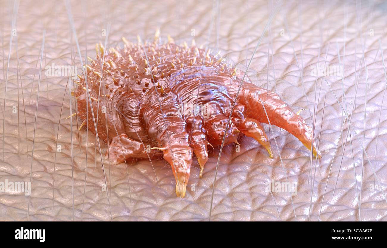 Illustration of Sarcoptes scabiei, the mite responsible for scabies ...