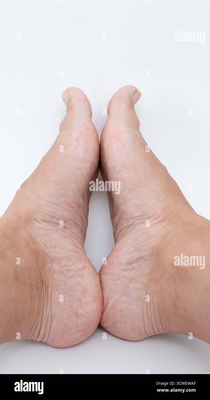 Varicose prevention hi-res stock photography and images - Alamy