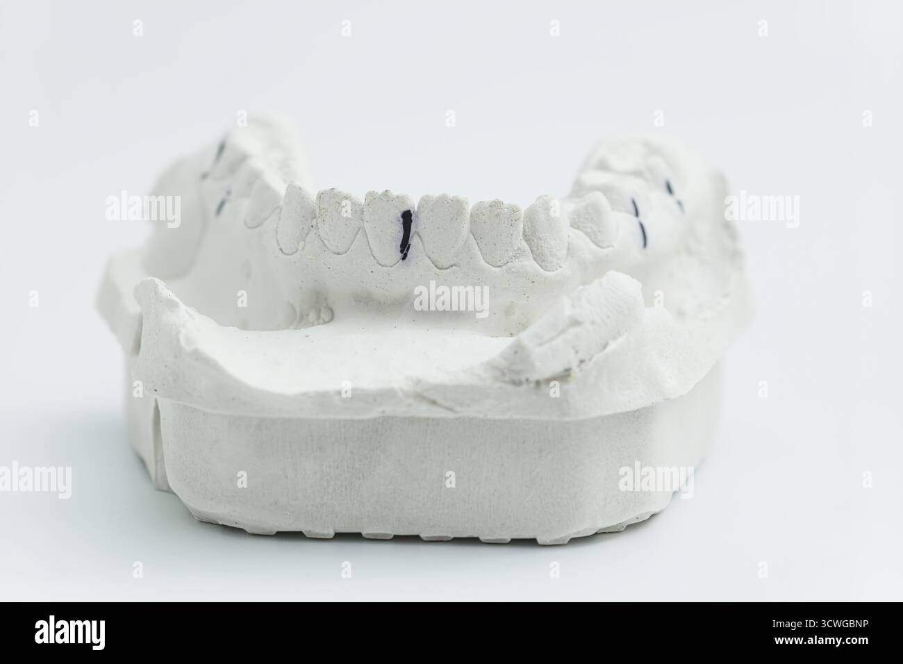 Close-up of a lower jaw dental cast showing occlusal ink markings used ...