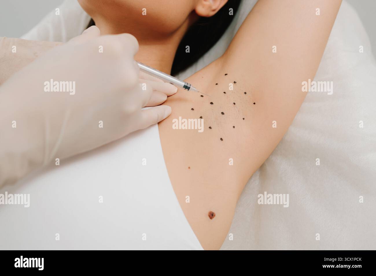 Hyperhidrosis injection for underarm. Intradermal injection procedure ...