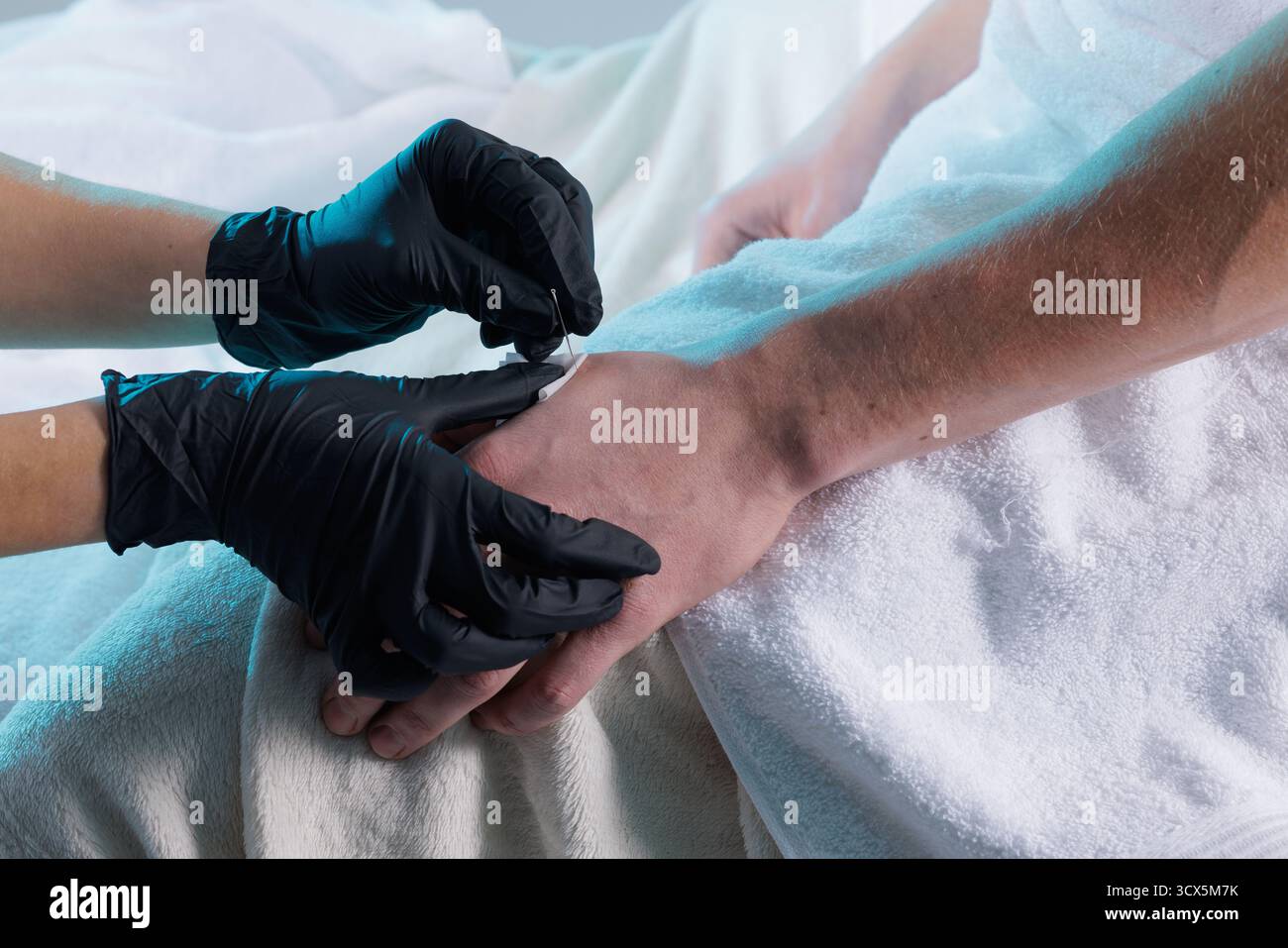Therapist places sterile acupuncture hi-res stock photography and ...