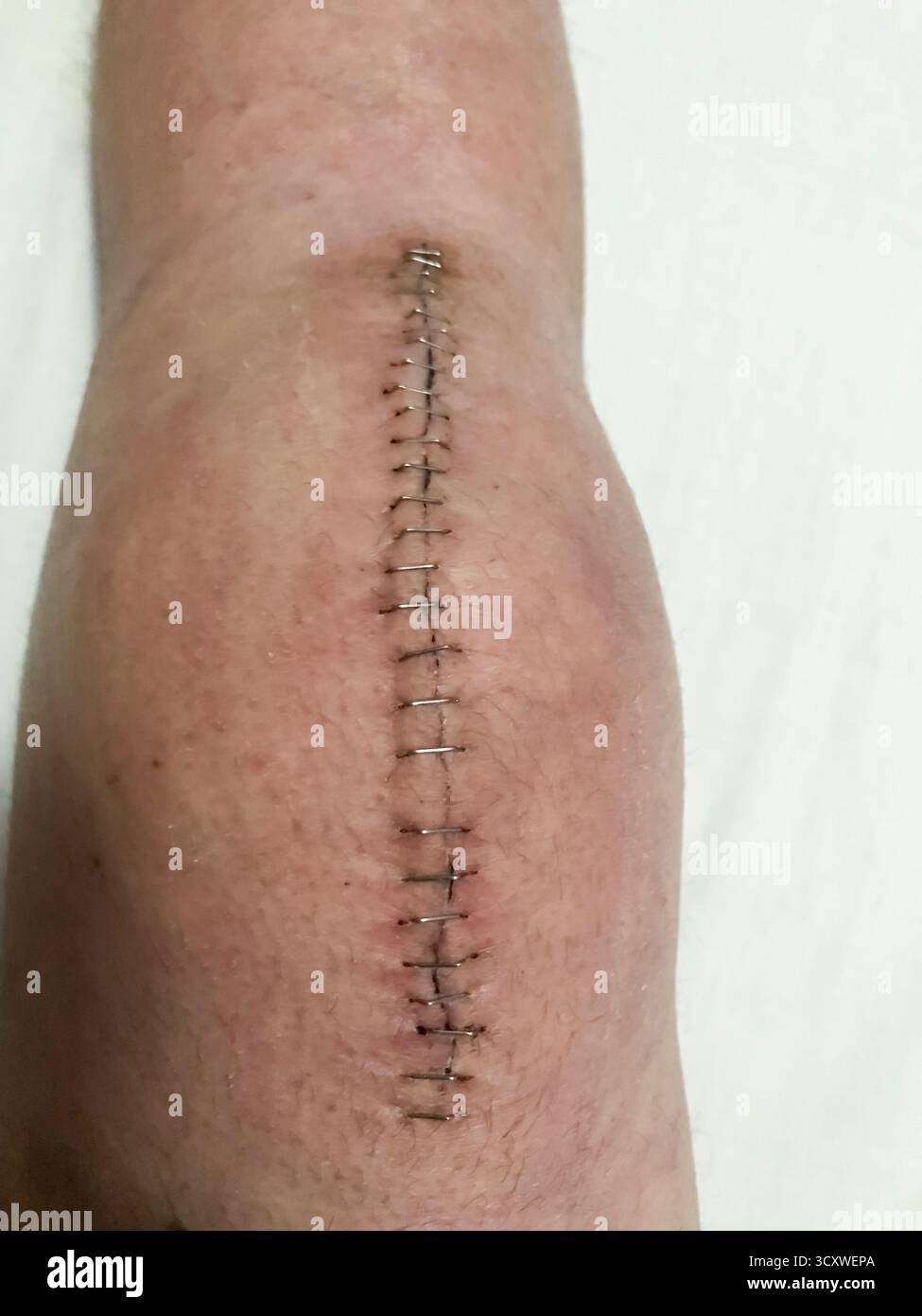 Scab scar hi-res stock photography and images - Alamy
