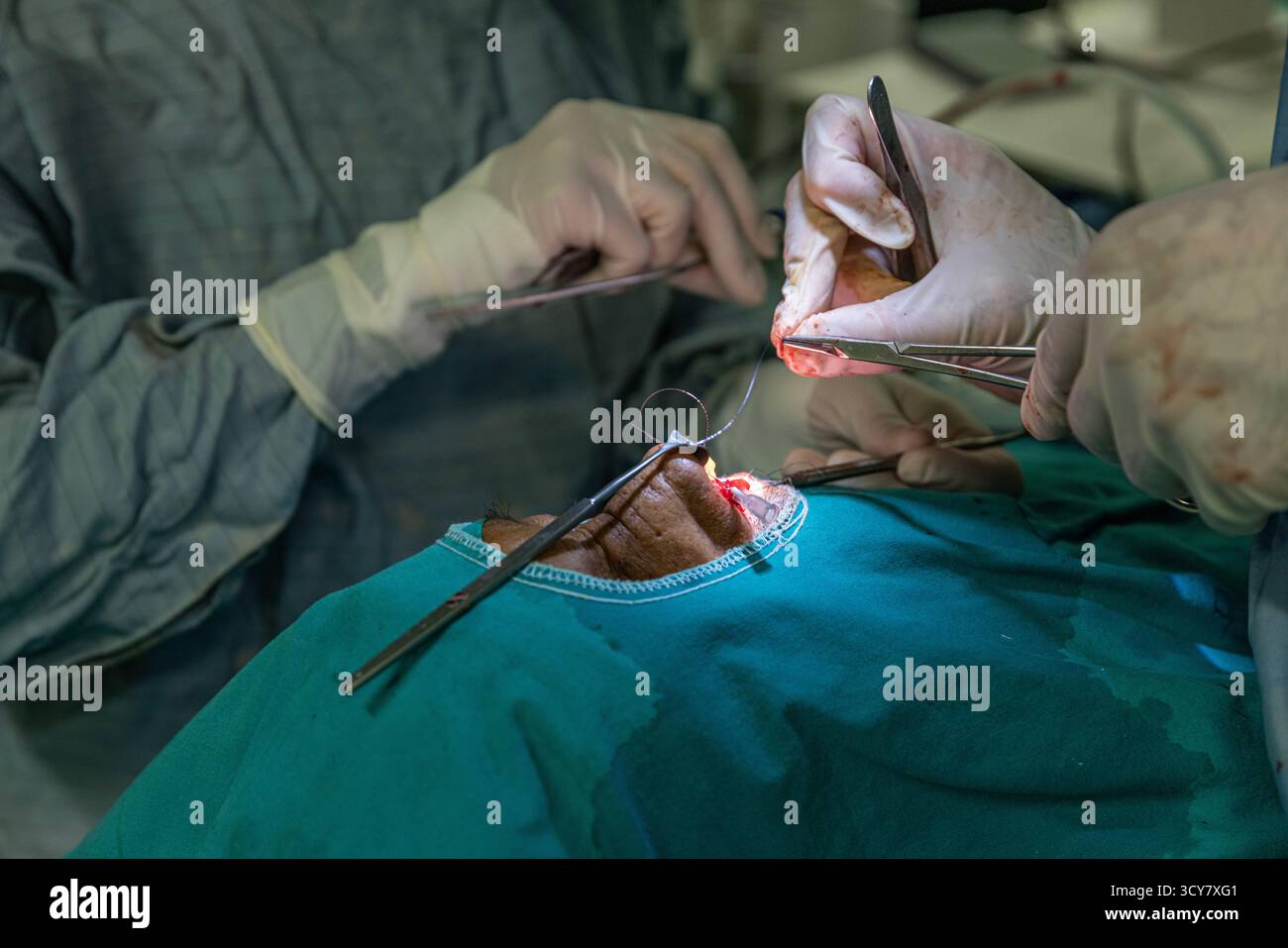 A cosmetic surgeon uses a nasal retractor to hold back a flap of skin ...
