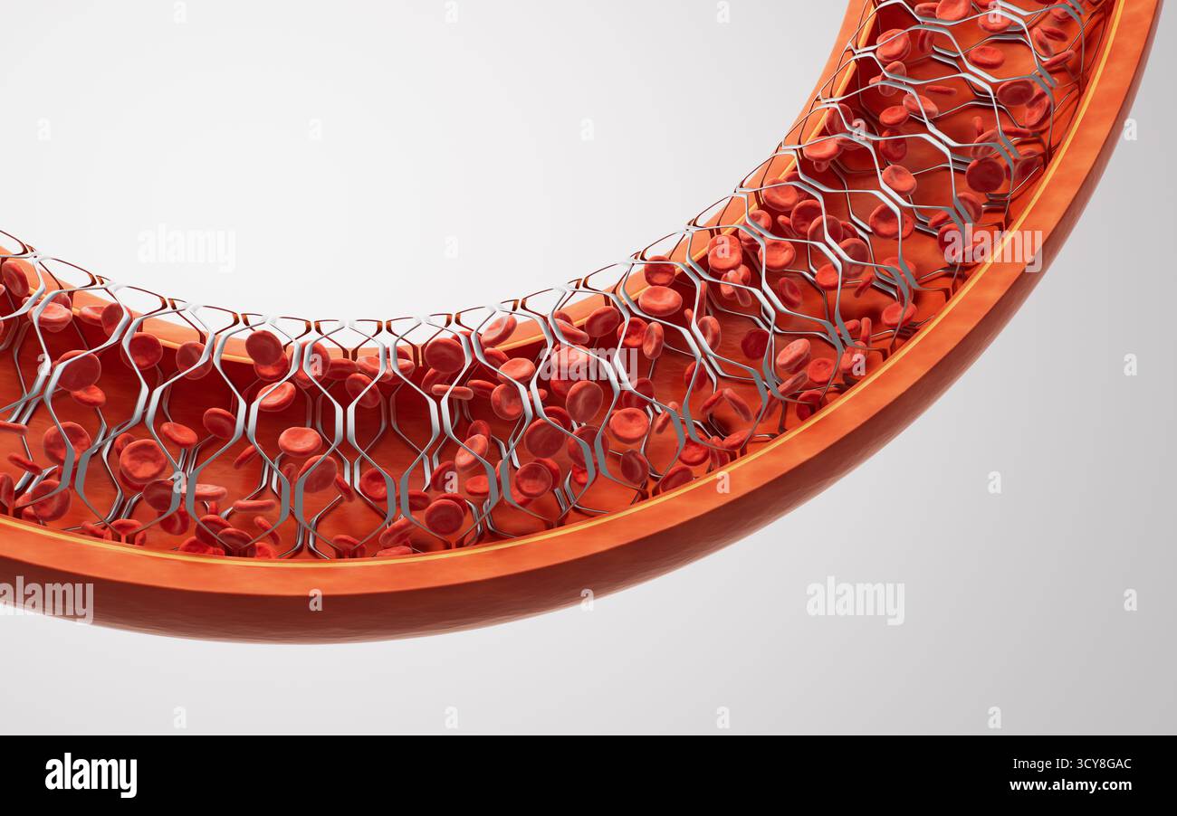 Blood vessel with coronary stent in it, 3d rendering. 3D illustration ...
