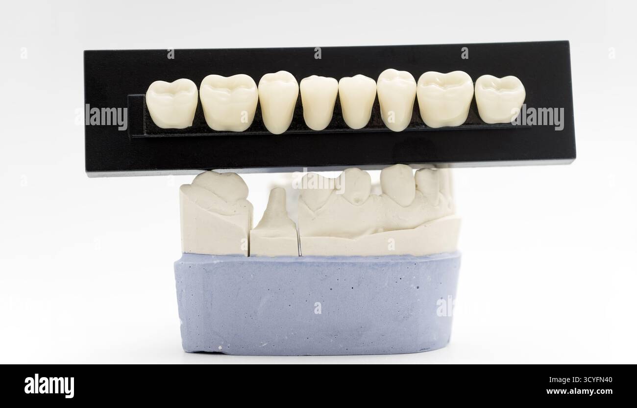 Set of artificial dental crowns displayed above a plaster model with ...