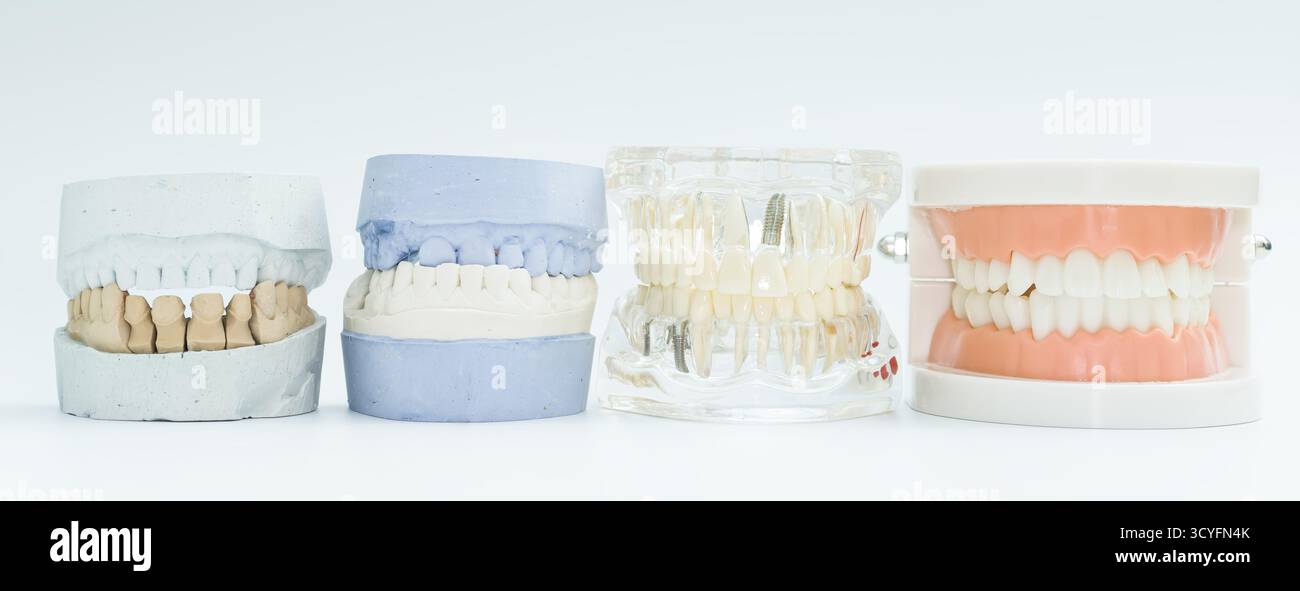 Four types of dental models showing plaster casts, implant ...