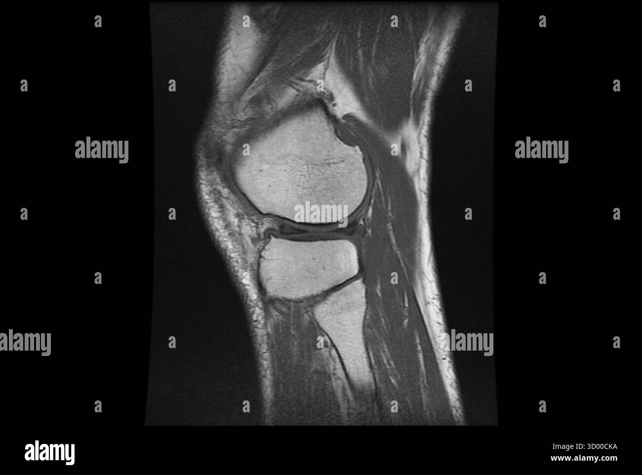 Negative X-ray image of a human knee rheumatism Negative X ray image of ...