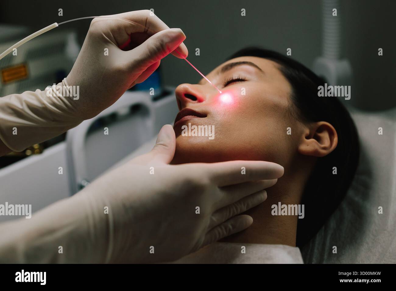 Laser dermatologic treatment for nevus and mole removal. Aesthetic ...