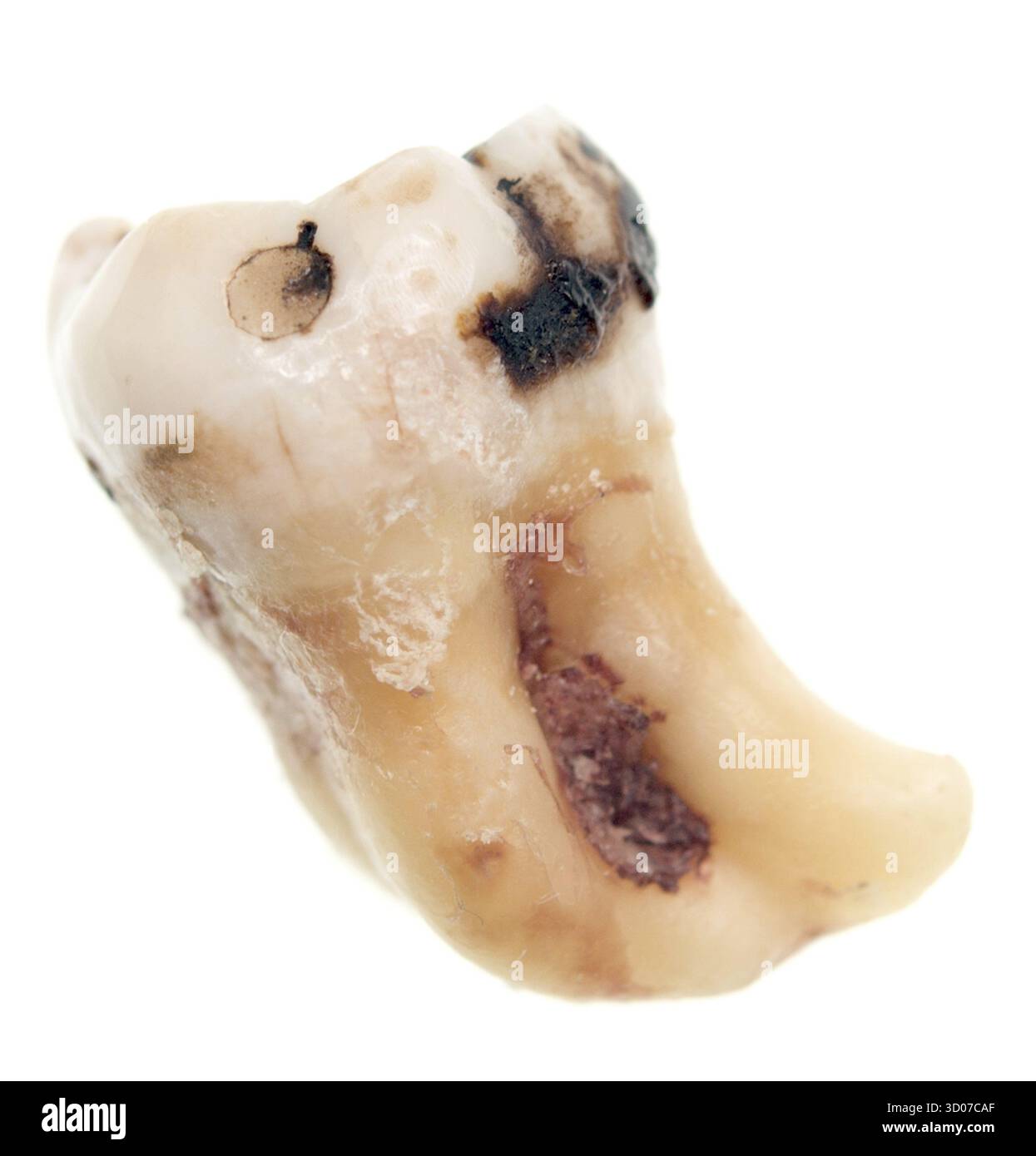 Wisdom tooth blood hi-res stock photography and images - Alamy