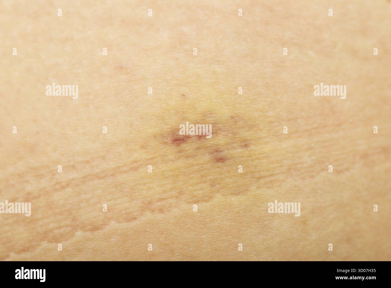 After injection hi-res stock photography and images - Alamy