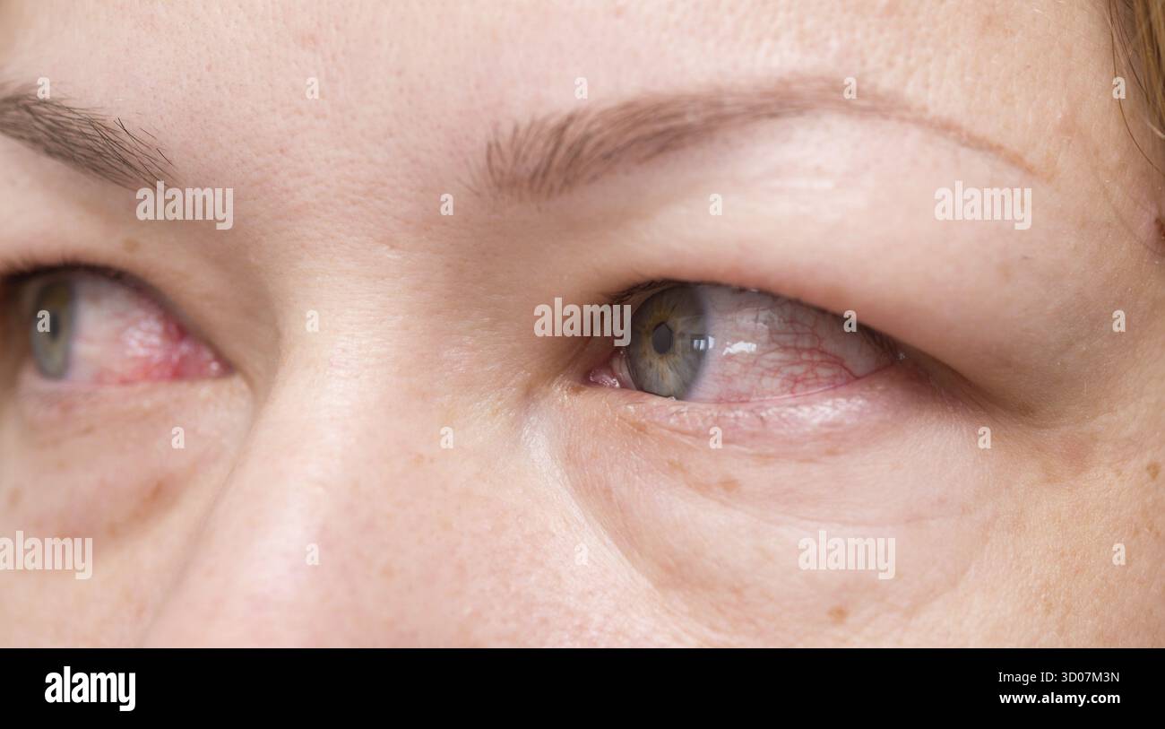 Red inflamed eye close hi-res stock photography and images - Alamy