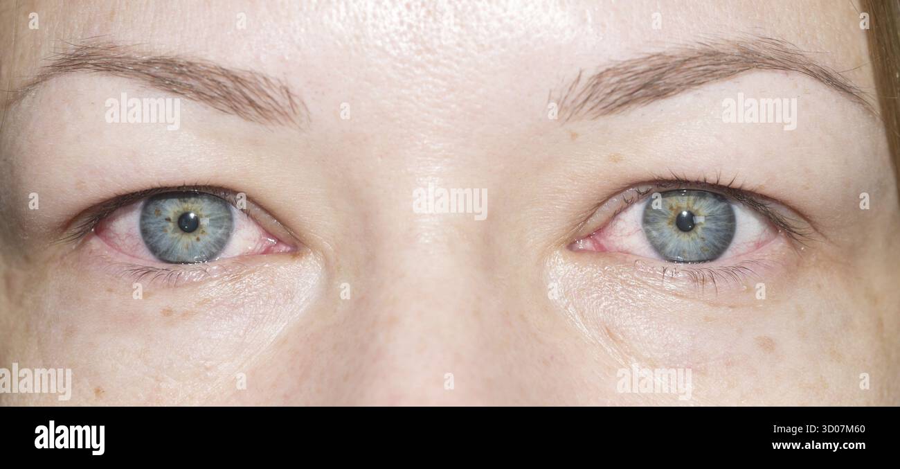 Red inflamed eye close hi-res stock photography and images - Alamy