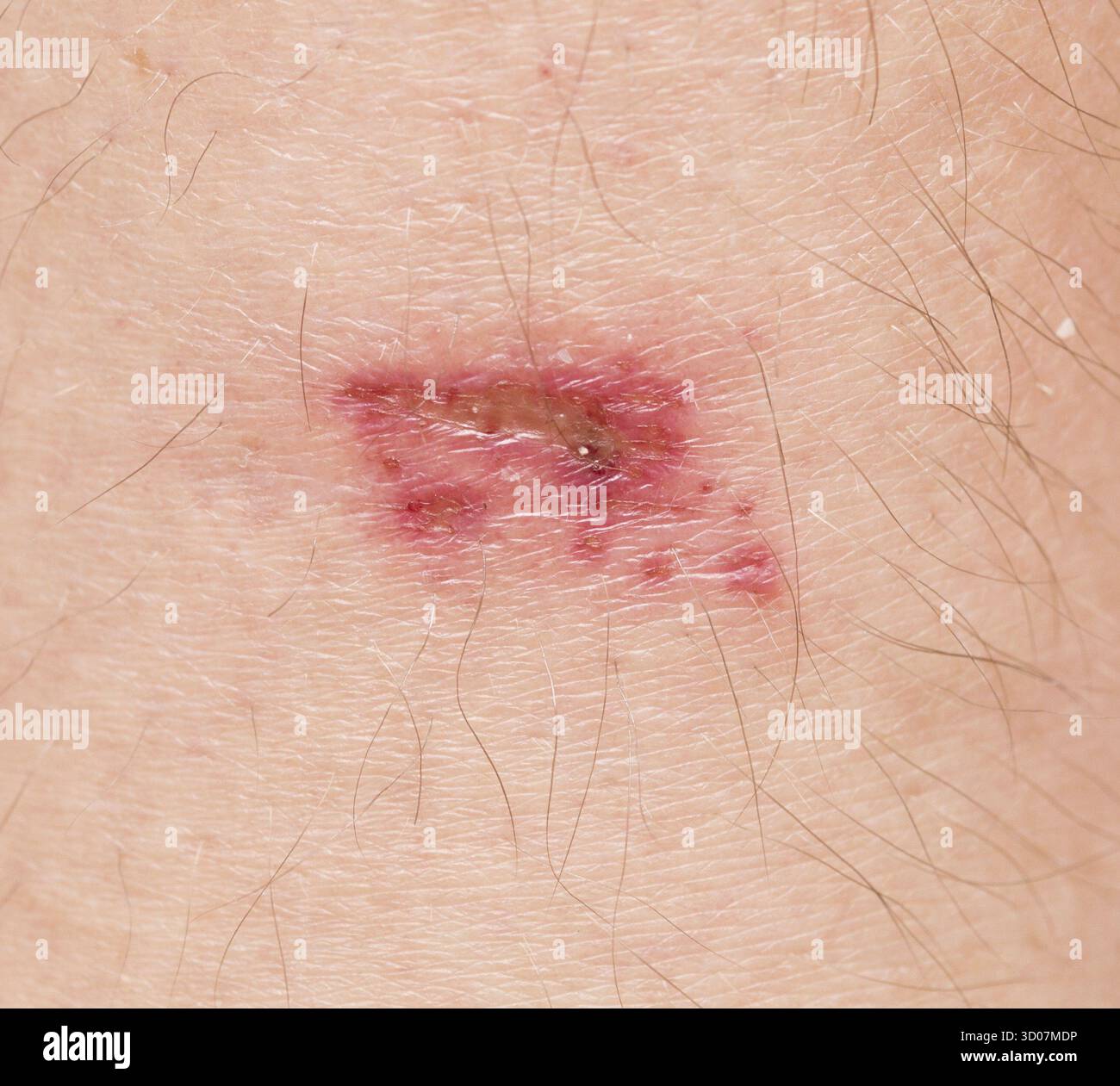 Sick skin hi-res stock photography and images - Alamy