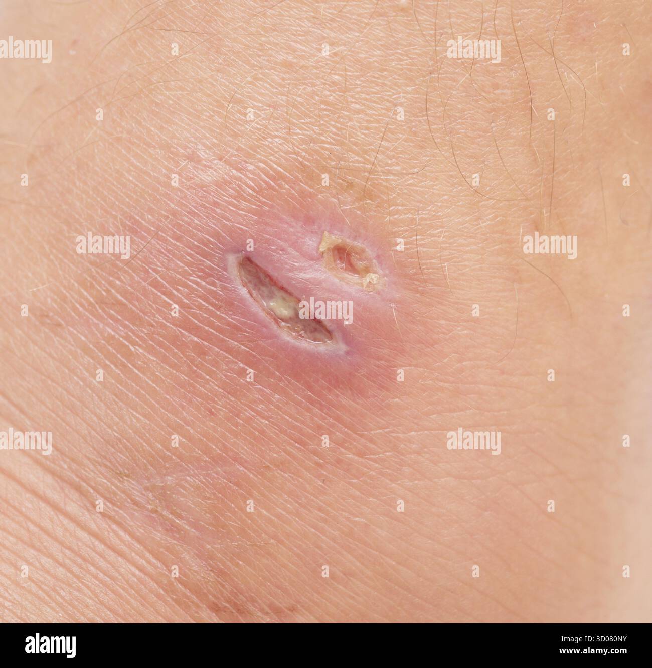 Wound on human skin Stock Photo - Alamy