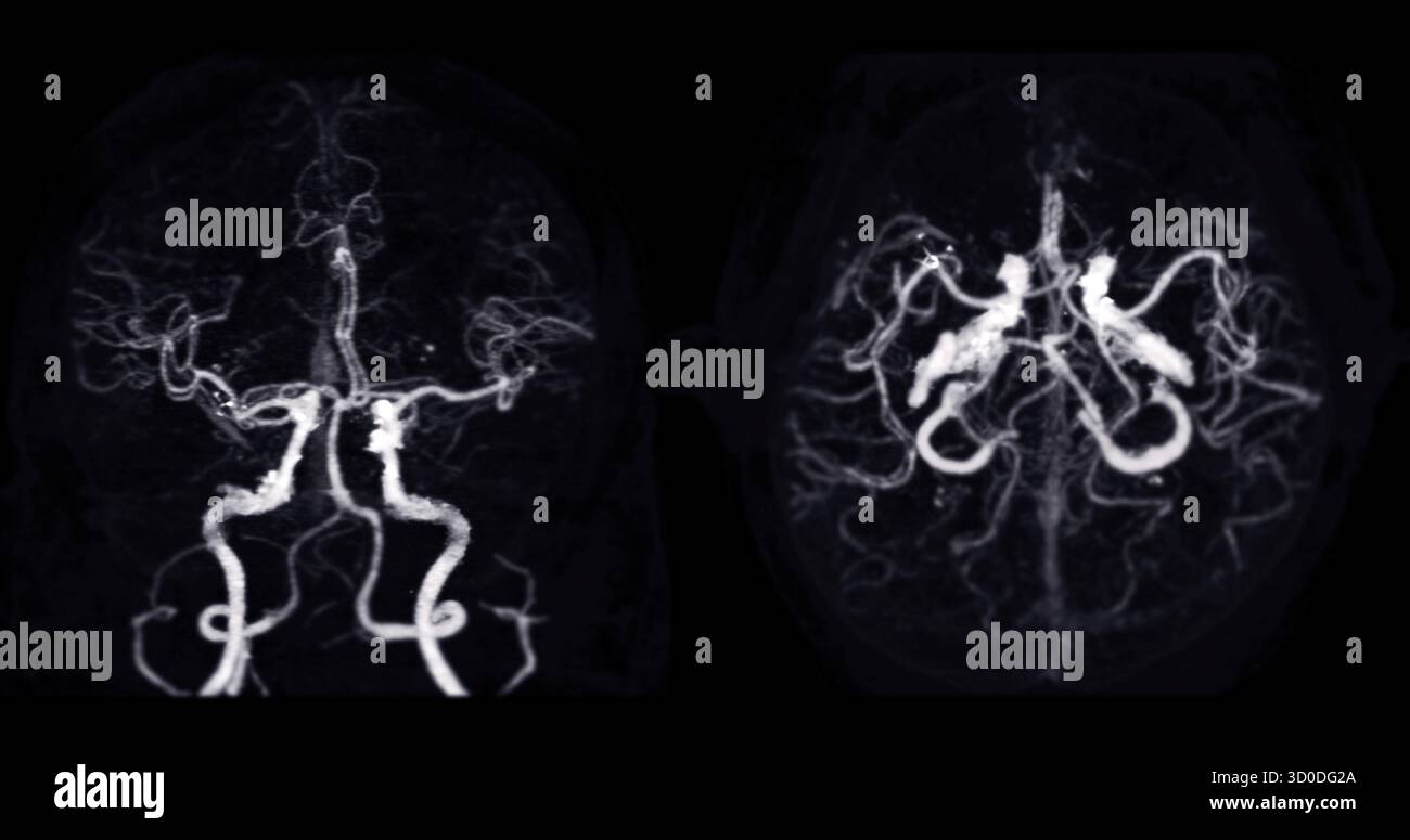 CTA Brain Vascular Imaging , highlights a detailed 3D CTA scan of the ...