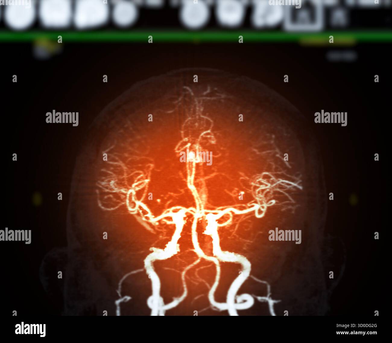 CTA Brain Vascular Imaging , highlights a detailed 3D CTA scan of the ...