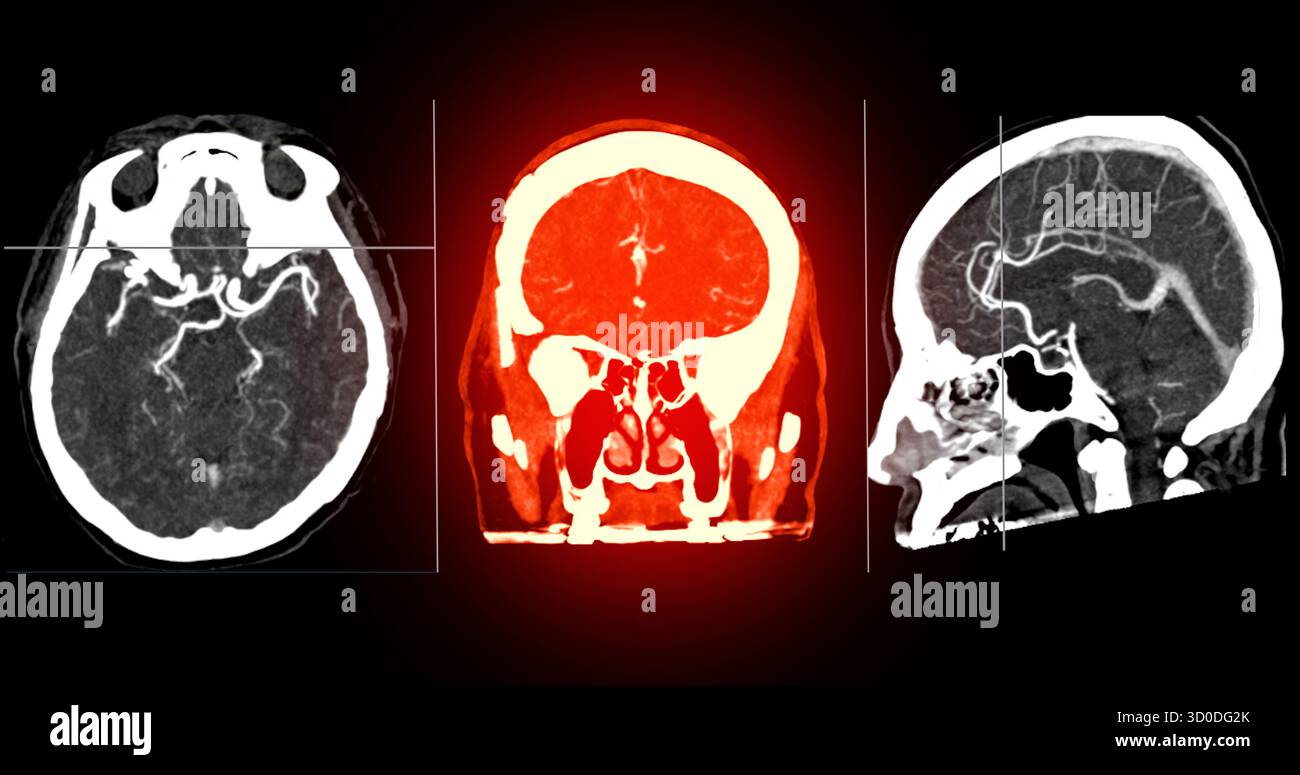 CTA Brain Vascular Imaging , highlights a detailed 3D CTA scan of the ...