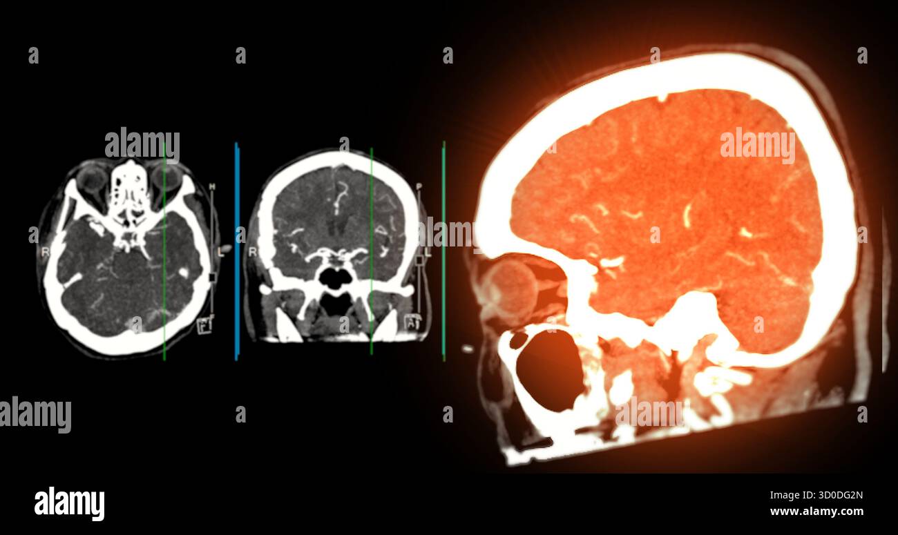 CTA Brain Vascular Imaging , highlights a detailed 3D CTA scan of the ...