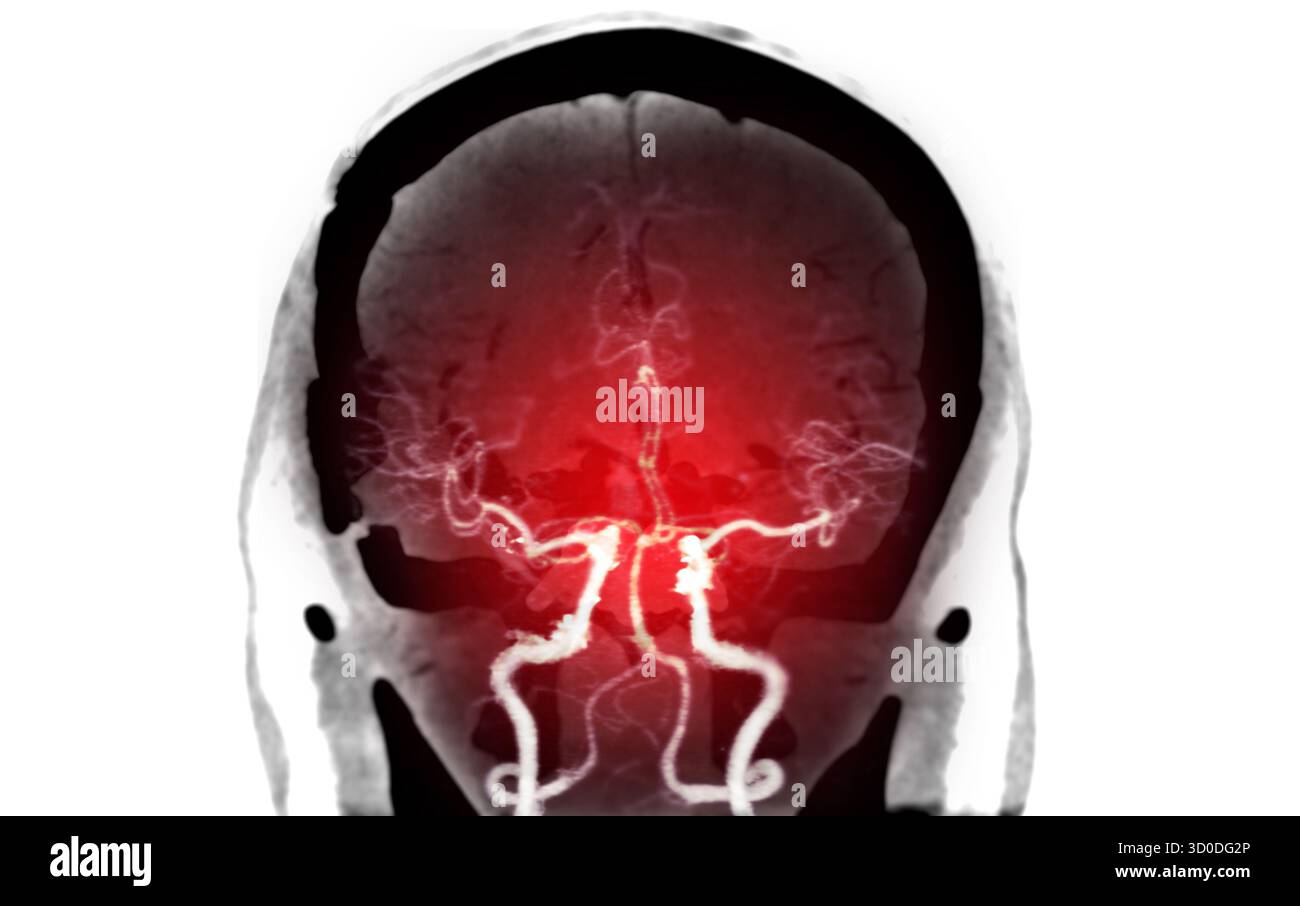 CTA Brain Vascular Imaging , highlights a detailed 3D CTA scan of the ...