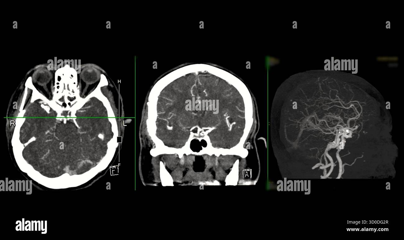 CTA Brain Vascular Imaging , highlights a detailed 3D CTA scan of the ...