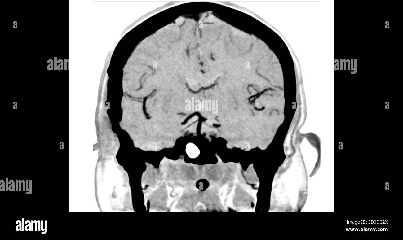 CTA Brain Vascular Imaging , highlights a detailed 3D CTA scan of the ...