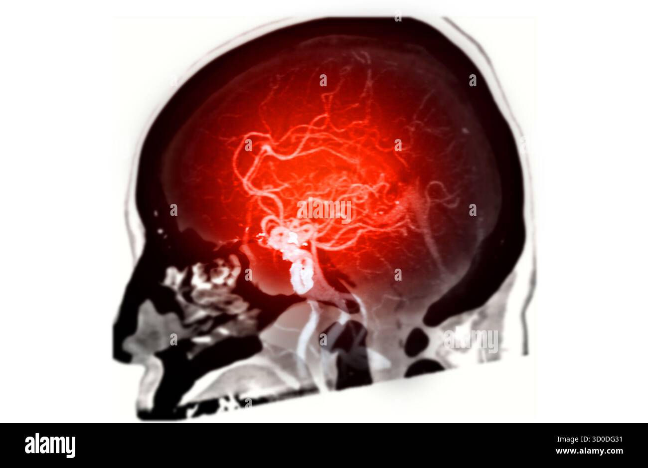CTA Brain Vascular Imaging , highlights a detailed 3D CTA scan of the ...
