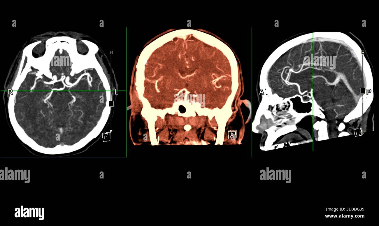 CTA Brain Vascular Imaging , highlights a detailed 3D CTA scan of the ...