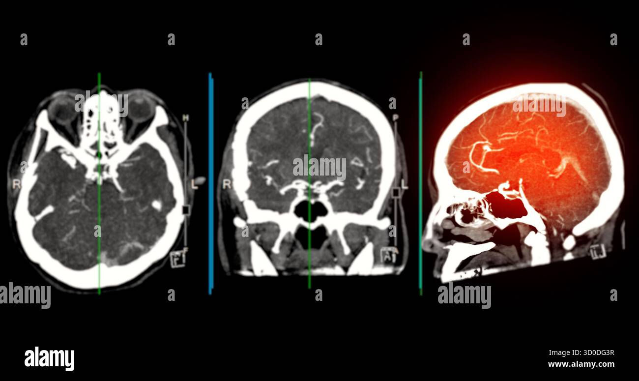 CTA Brain Vascular Imaging , highlights a detailed 3D CTA scan of the ...