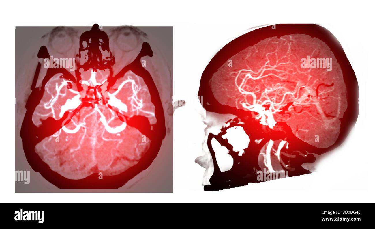 CTA Brain Vascular Imaging , highlights a detailed 3D CTA scan of the ...