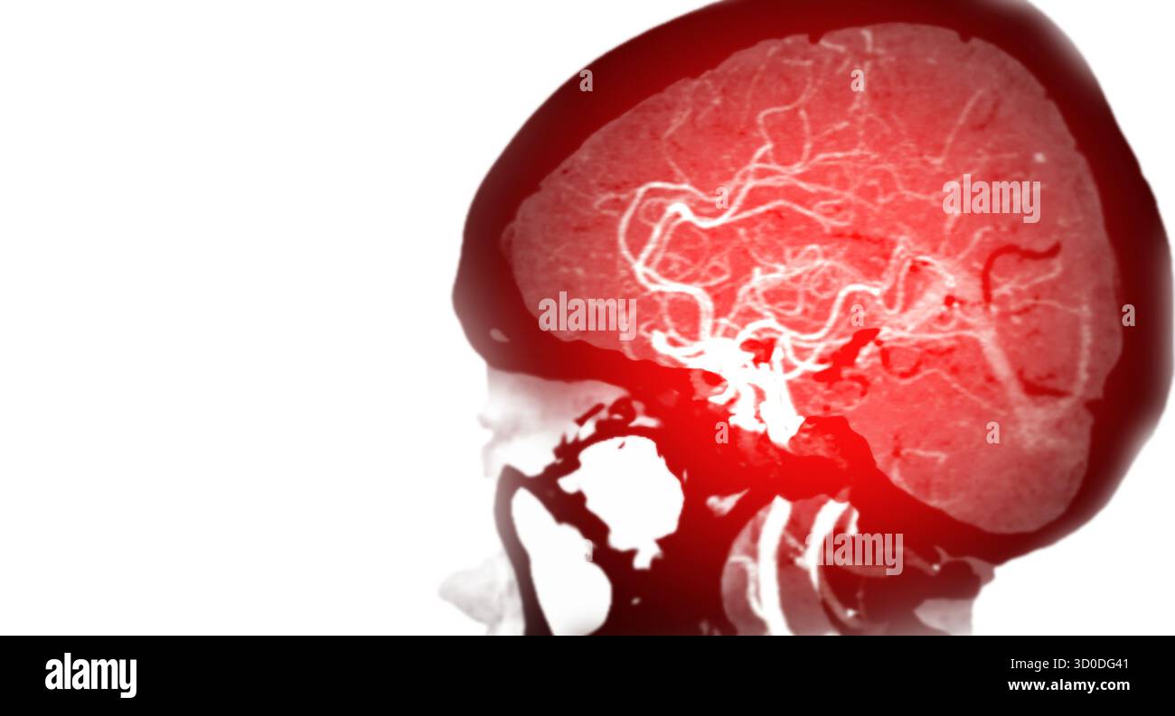 CTA Brain Vascular Imaging , highlights a detailed 3D CTA scan of the ...