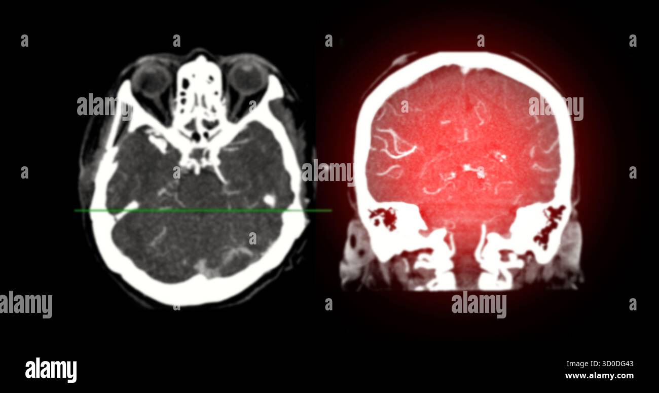 CTA Brain Vascular Imaging , highlights a detailed 3D CTA scan of the ...