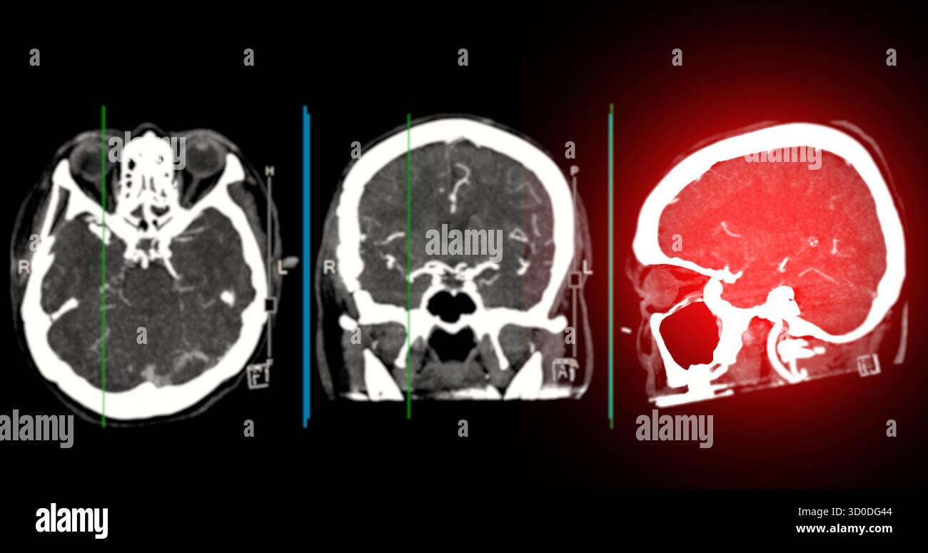 CTA Brain Vascular Imaging , highlights a detailed 3D CTA scan of the ...