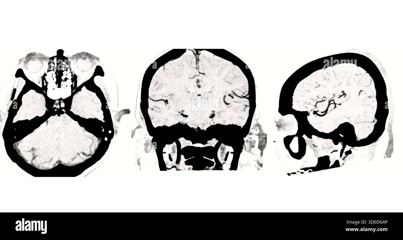 CTA Brain Vascular Imaging , highlights a detailed 3D CTA scan of the ...