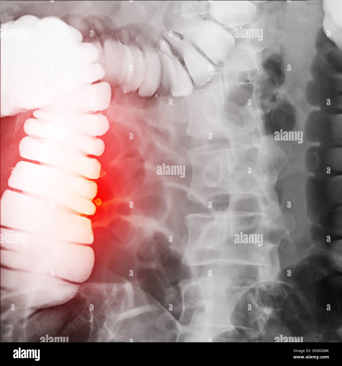 A diagnostic barium enema image showing the presence of diverticulosis ...
